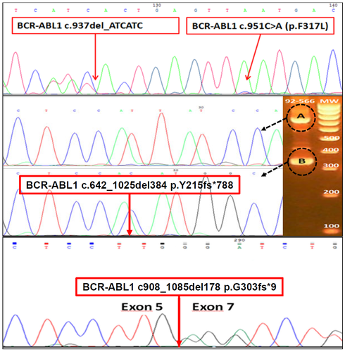 NOVEL BCR-ABL1 KINASE DOMAIN MUTATIONS IN RUSSIAN PATIENTS.... EHA ...